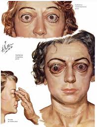 BLOG PARA EL ESTUDIANTE DE MEDICINA..: Enfermedad de Graves-Basedow
