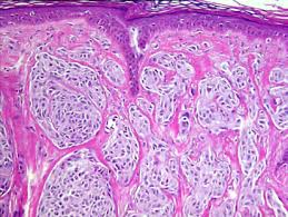 Pathology Outlines - Nevoid melanoma