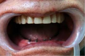 英和画像辞典：(toothless gum)の関連画像一覧！ – おもしろい英文法